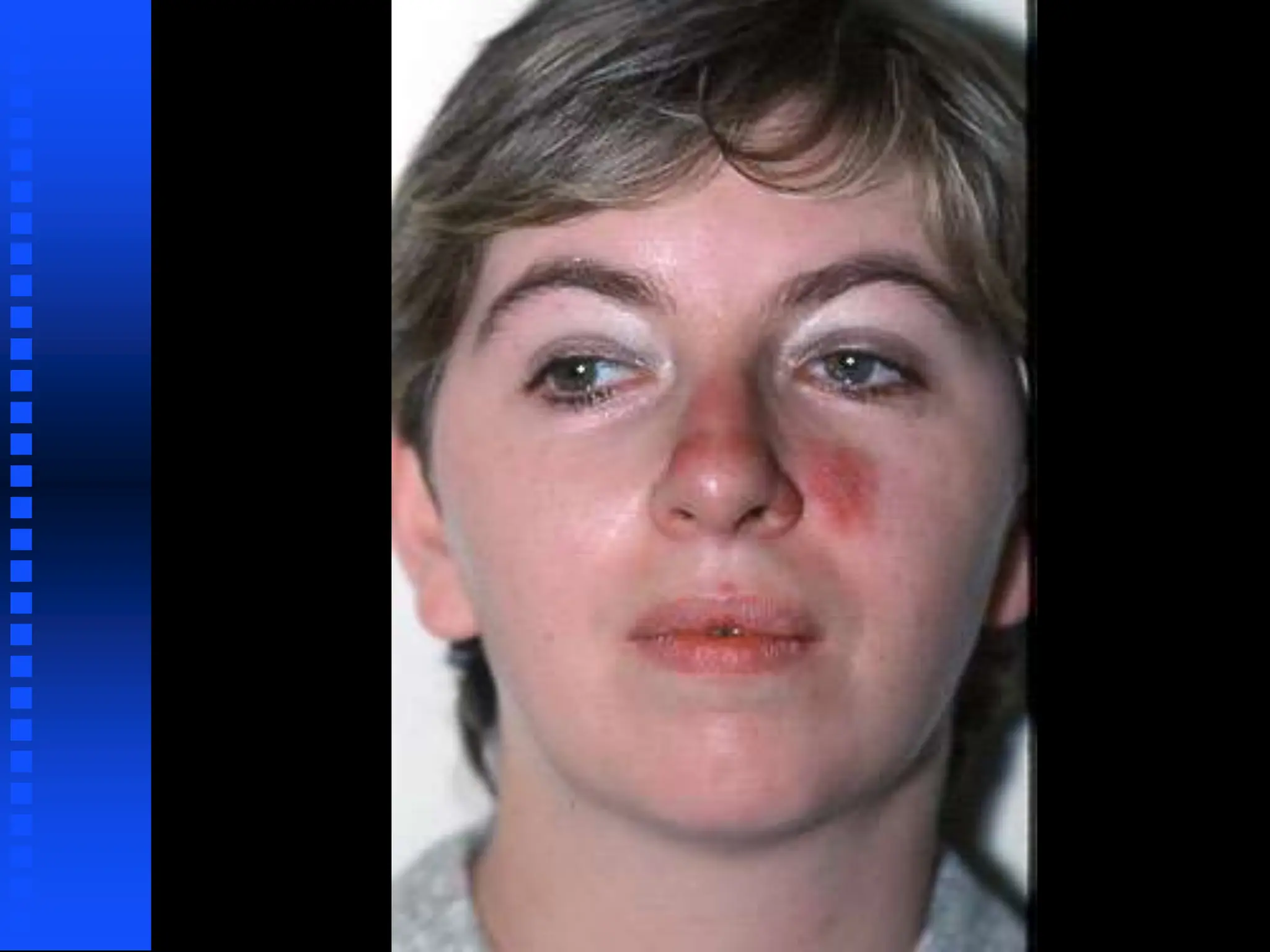 an introduction to dermatology including rash.ppt