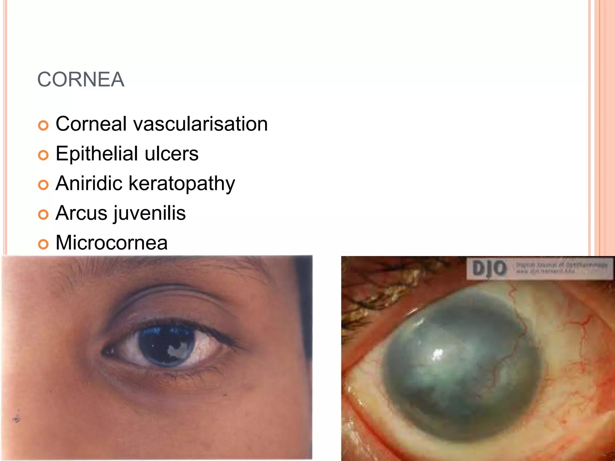 Aniridia and low vision | PPTX