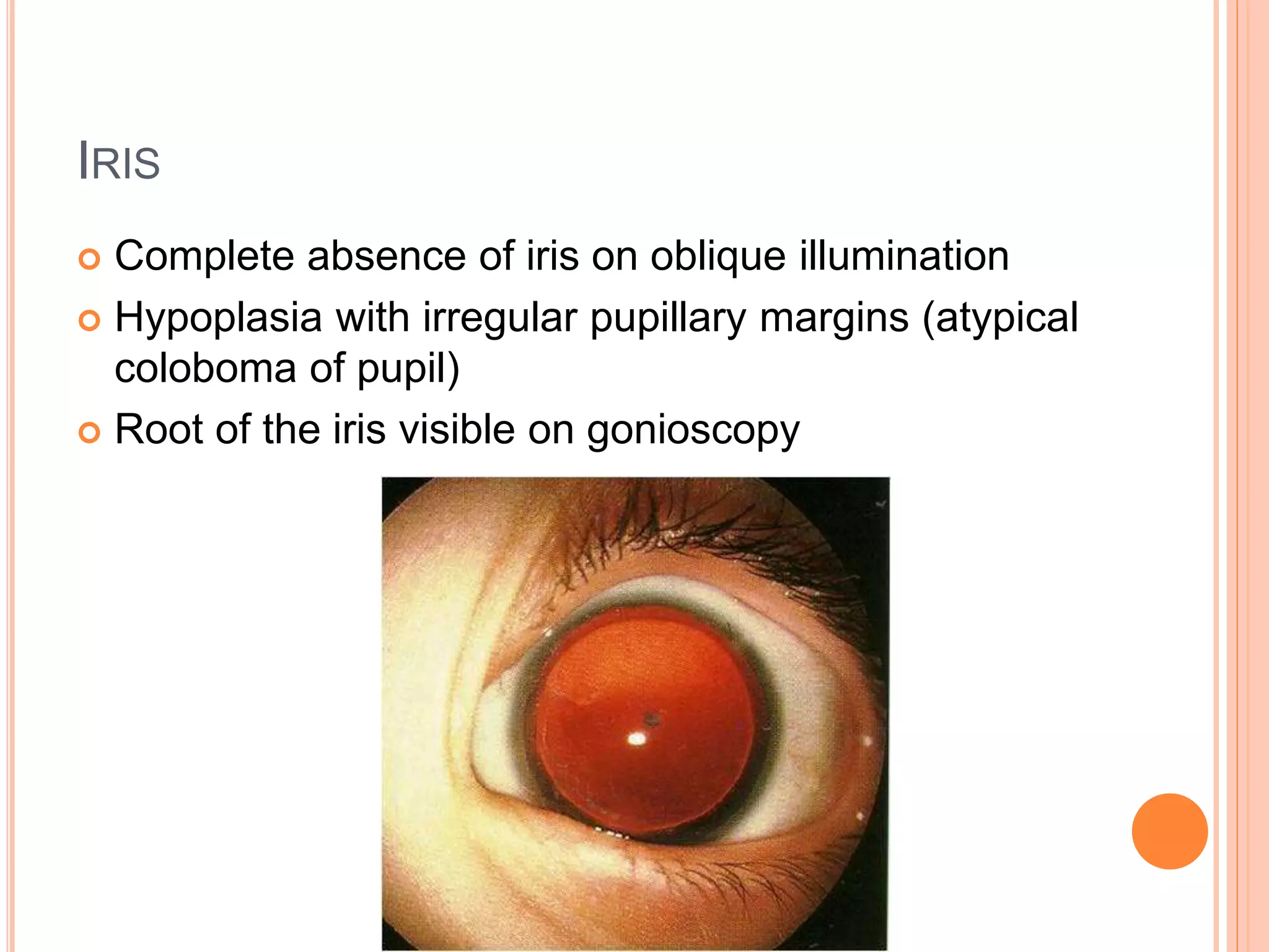 Aniridia and low vision | PPTX