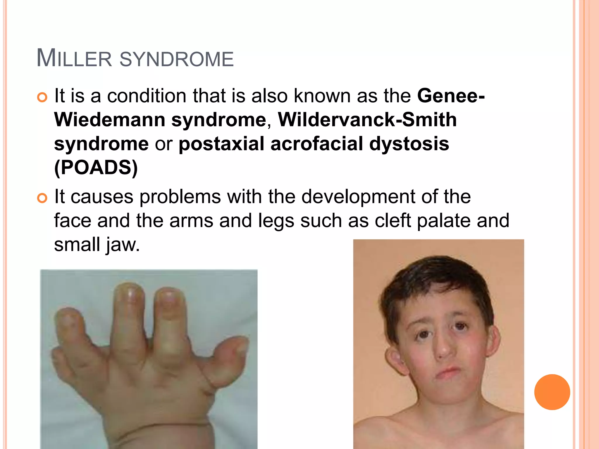 Aniridia and low vision | PPTX