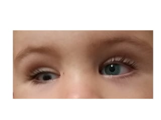 Aniridia, Microphthalmos, Coloboma, Albinism.ppt