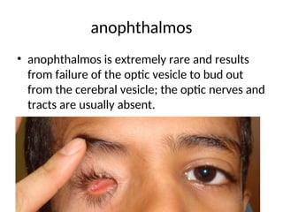 Aniridia, Microphthalmos, Coloboma, Albinism.ppt