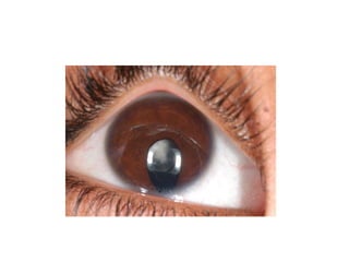 Aniridia, Microphthalmos, Coloboma, Albinism.ppt