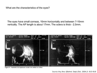 Aniridia, Microphthalmos, Coloboma, Albinism.ppt