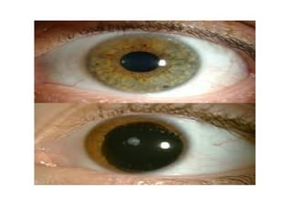 Aniridia, Microphthalmos, Coloboma, Albinism.ppt