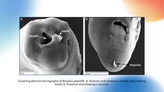 Anisakiasis: clinical, diagnosis, and treatment | PPTX