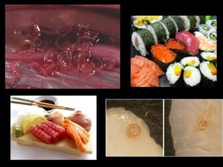 Anisakiasis | PPT