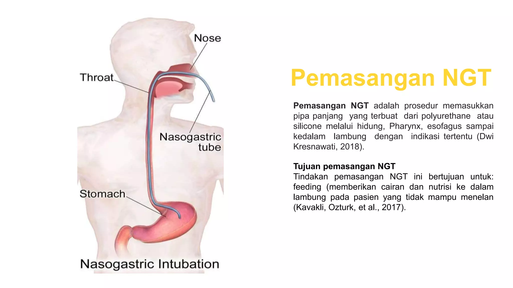 Kasus Pemasangan NGT pada Ny.R .pptx