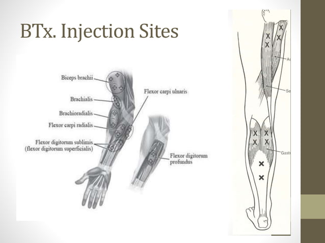 Cerebral Palsy Spasticity Management & Botox therapy | PPTX | Physical ...