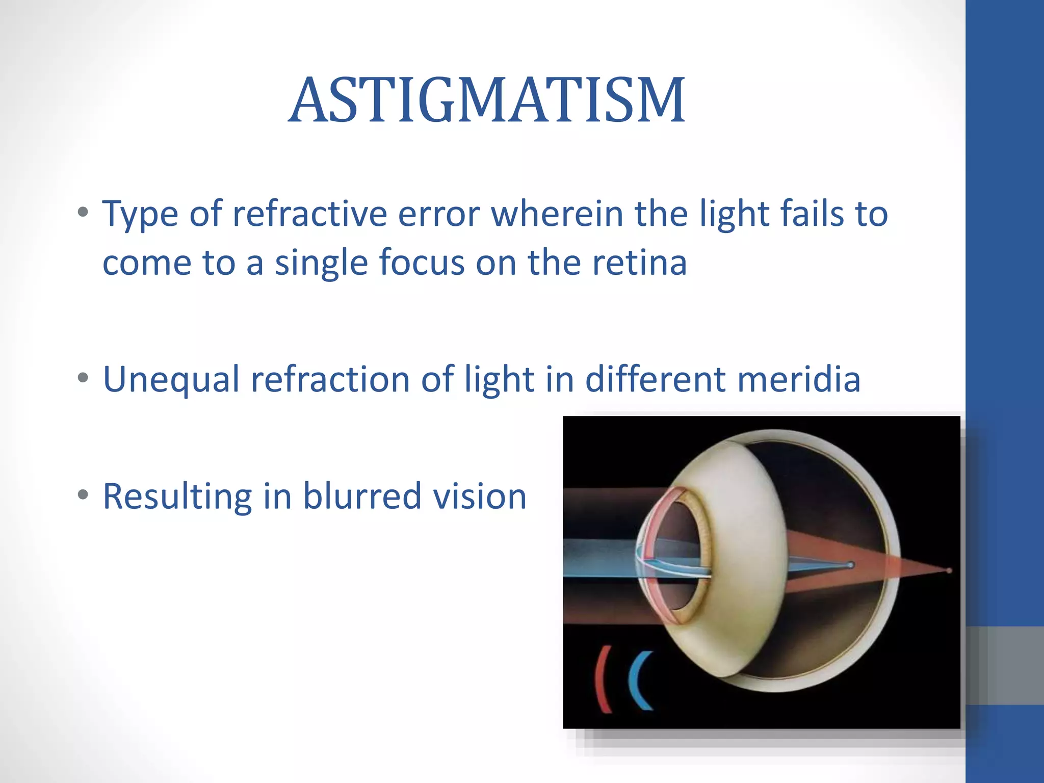Aniseikona , anisometropia & astigmatism | PPTX