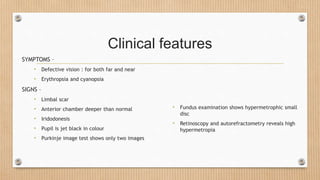 Aniseikonia [ophthalmology description for medical students ] | PPTX ...