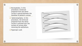 Aniseikonia [ophthalmology description for medical students ] | PPTX
