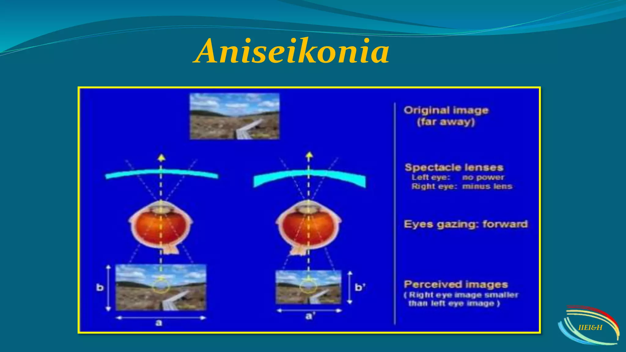Aniseikonia | PPTX