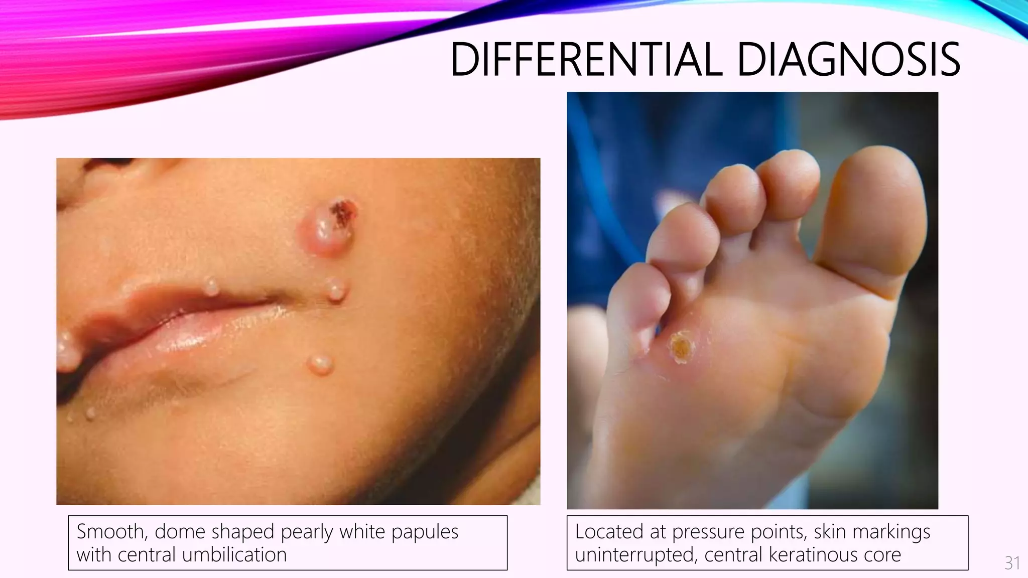 Warts (Verruca) by Dr. Aryan | PPTX