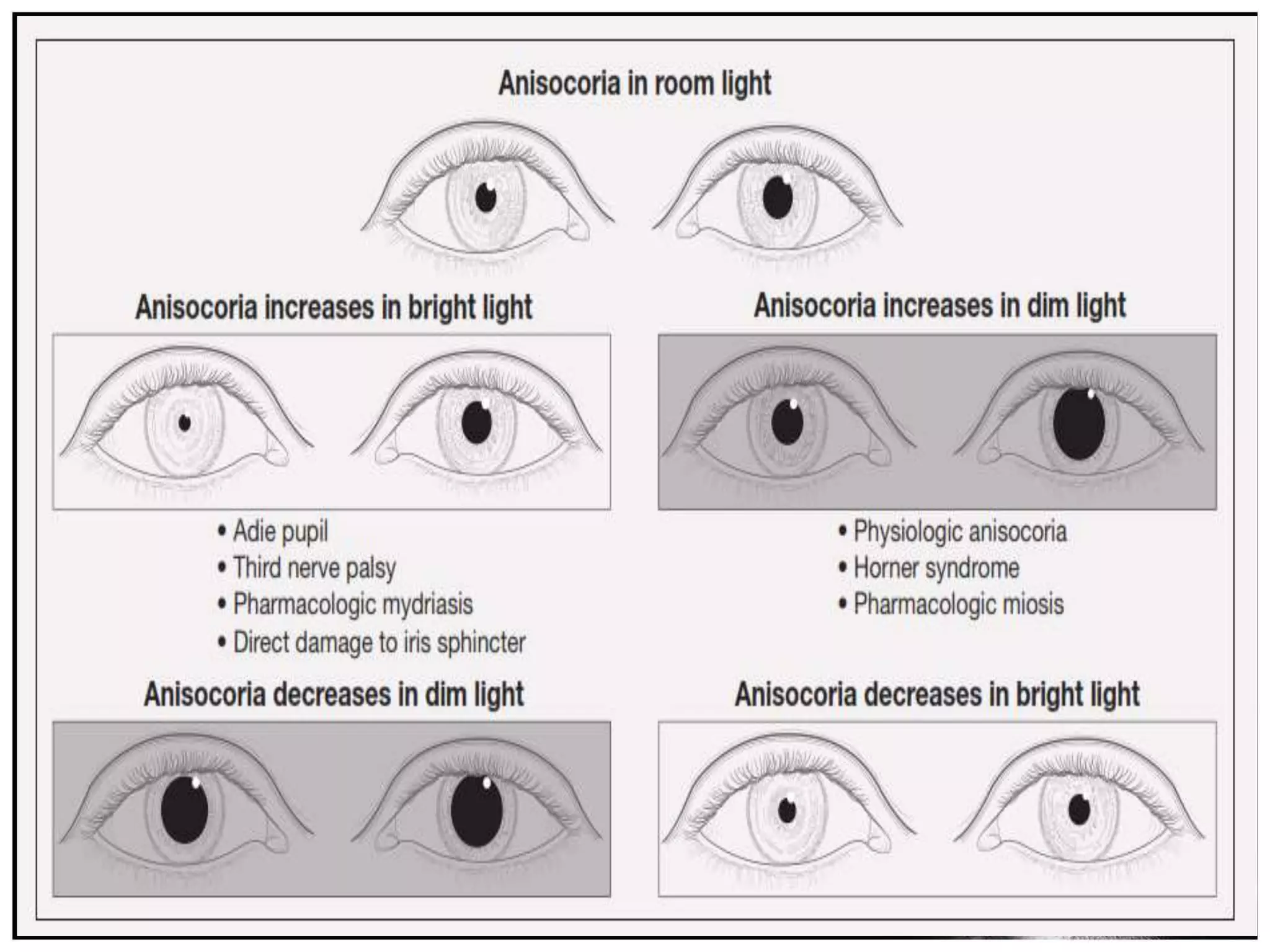 Anisocoria | PPTX