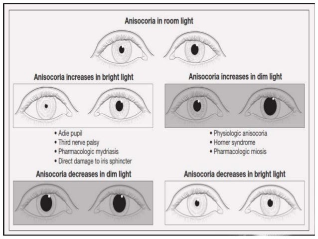 Anisocoria