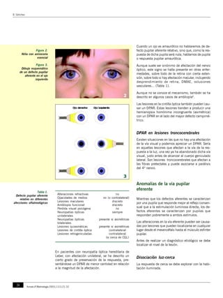 Anisocoria | PDF