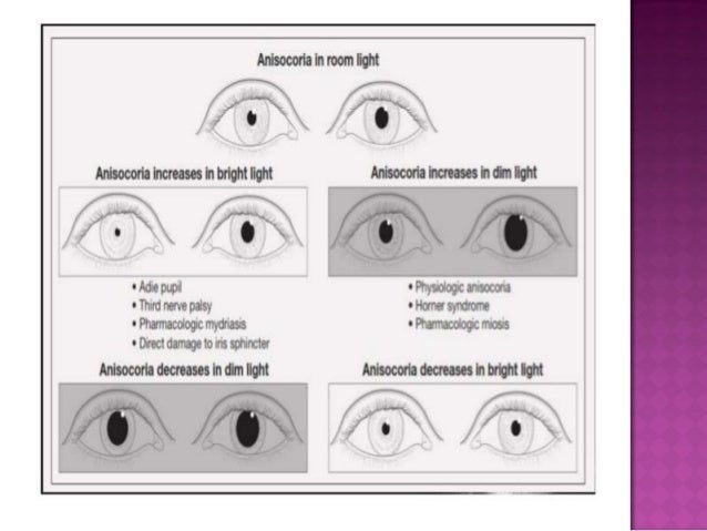 Anisocoria