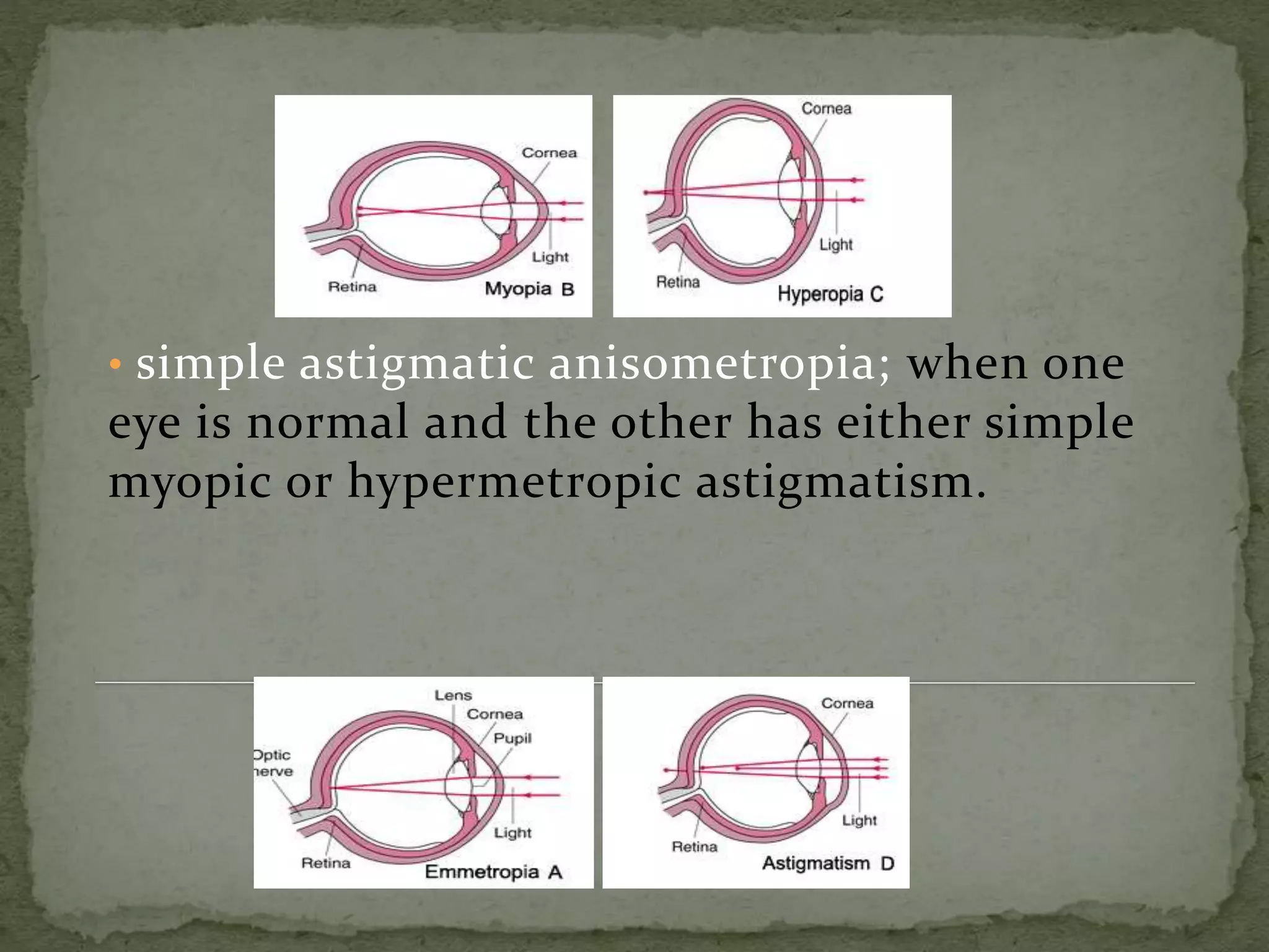 Anisometropia | PPTX