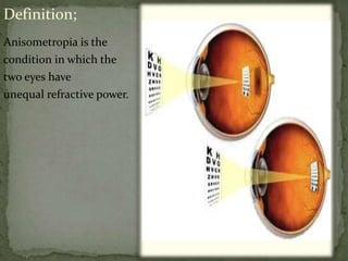 Anisometropia | PPT