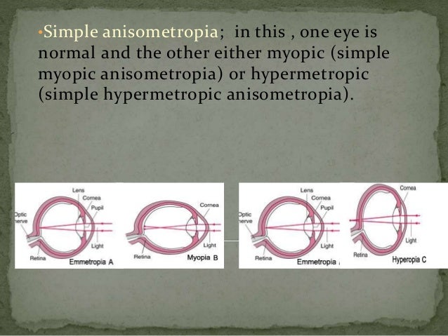 Anisometropia