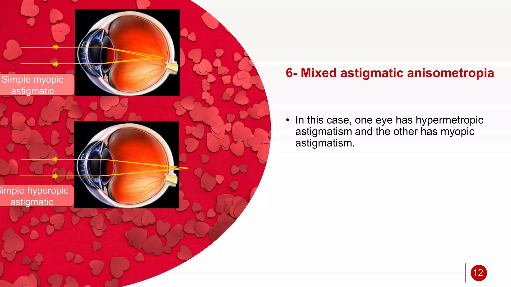 Anisometropia | PPTX