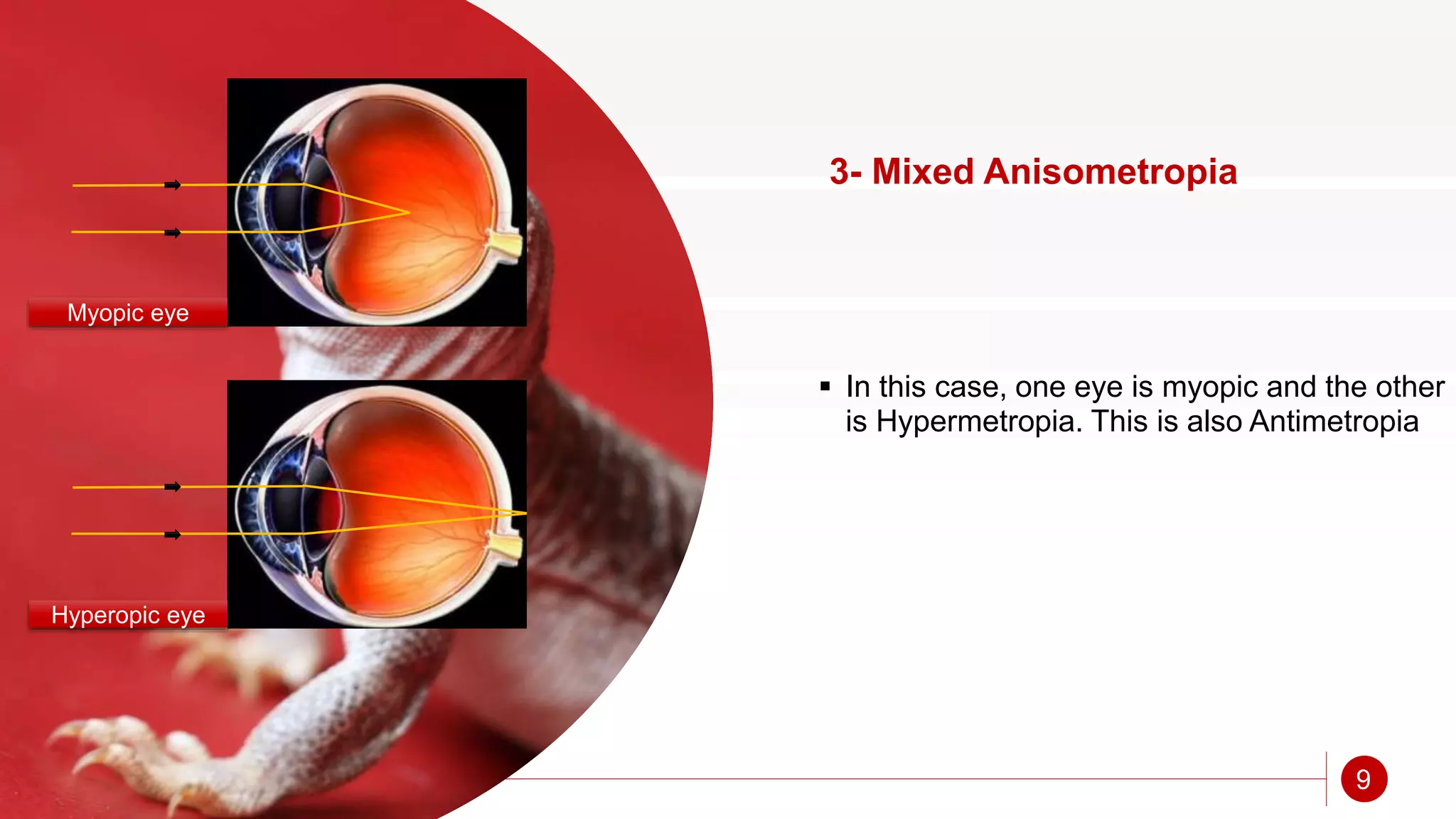 Anisometropia | PPTX