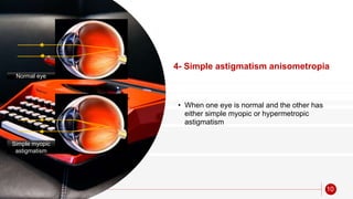 Anisometropia | PPTX