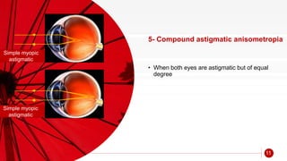 Anisometropia | PPTX
