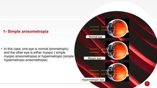 Anisometropia | PPTX