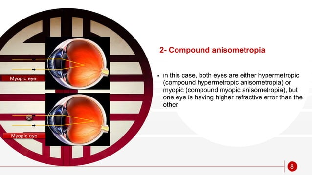 Anisometropia | PPTX | Eye and Vision Conditions | Diseases and Conditions