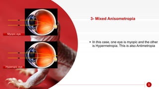 Anisometropia | PPTX