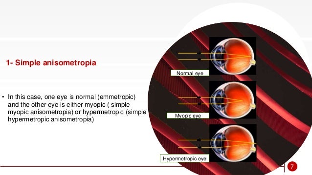 Anisometropia