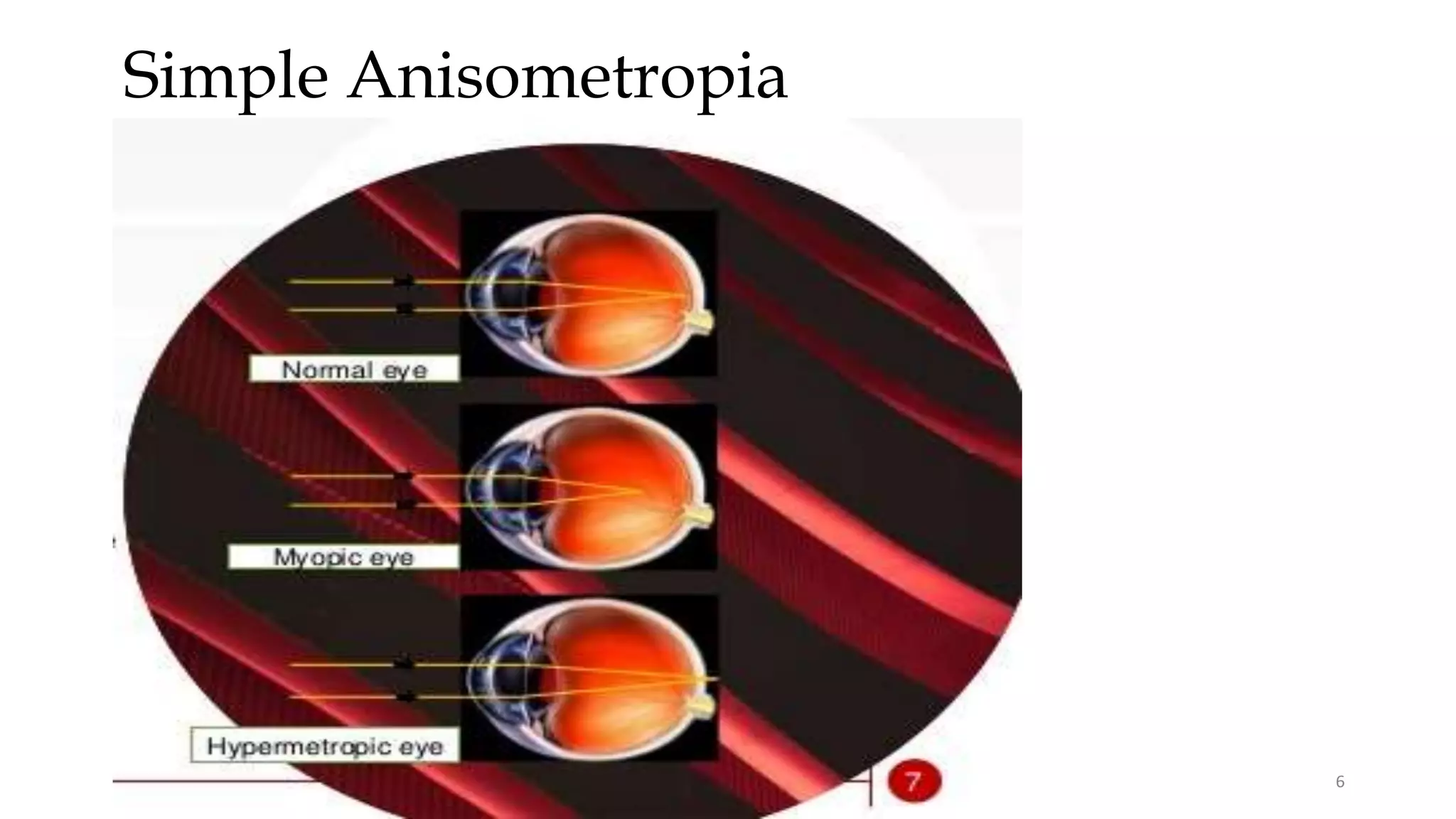 Anisometropia | PPTX