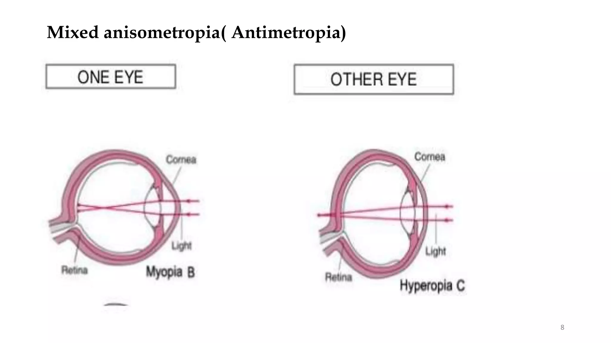 Anisometropia | PPTX