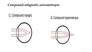 Anisometropia | PPTX