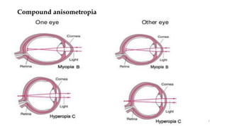 Anisometropia | PPTX