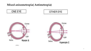 Anisometropia | PPTX