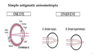 Anisometropia | PPTX
