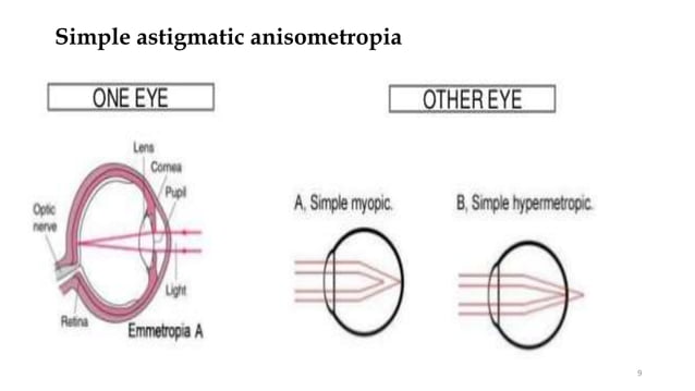 Anisometropia | PPTX