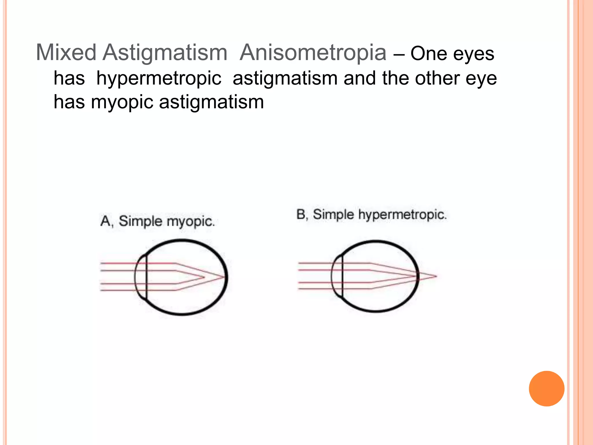 Anisometropia | PPTX
