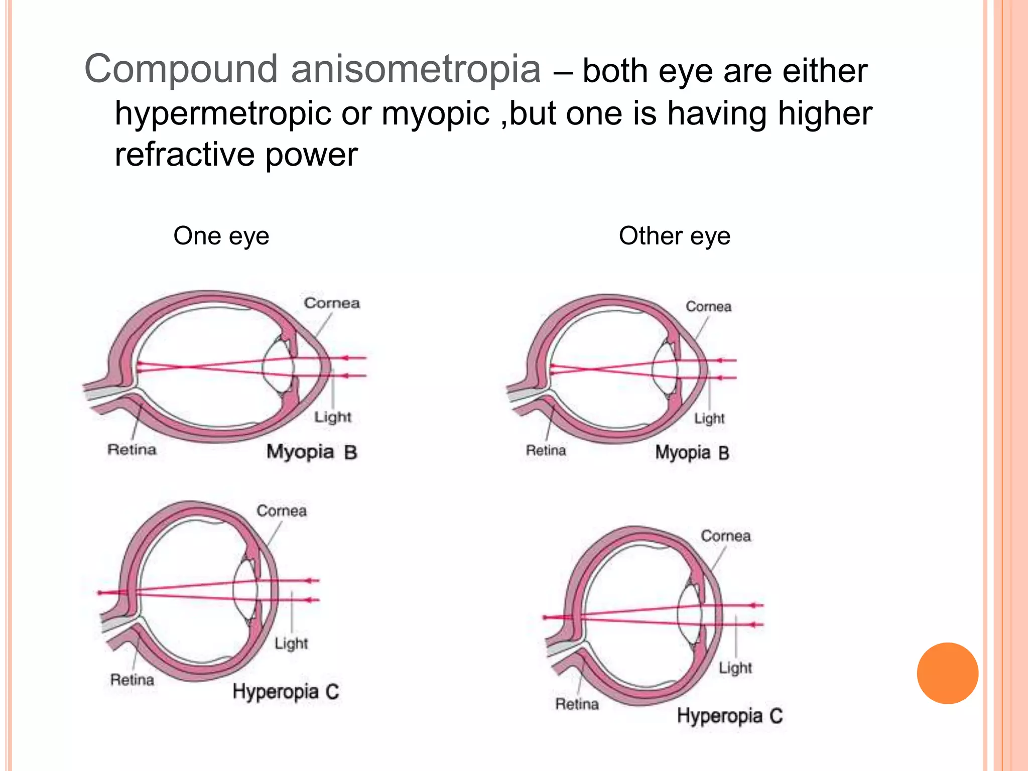 Anisometropia | PPTX