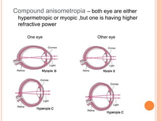 Anisometropia | PPTX