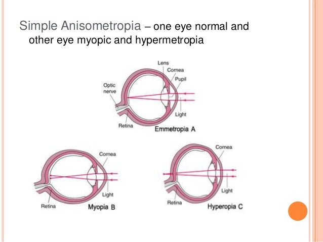 Anisometropia