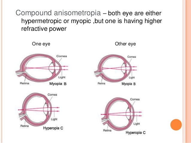 Anisometropia