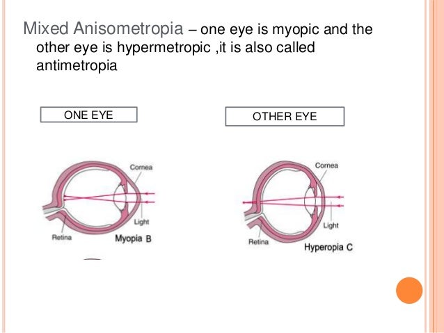 Anisometropia