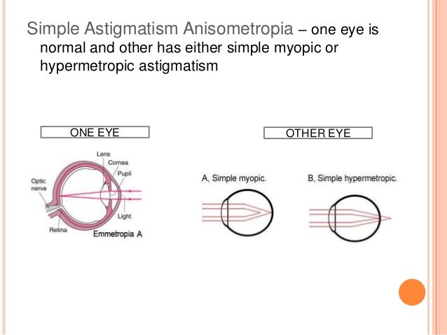 Anisometropia