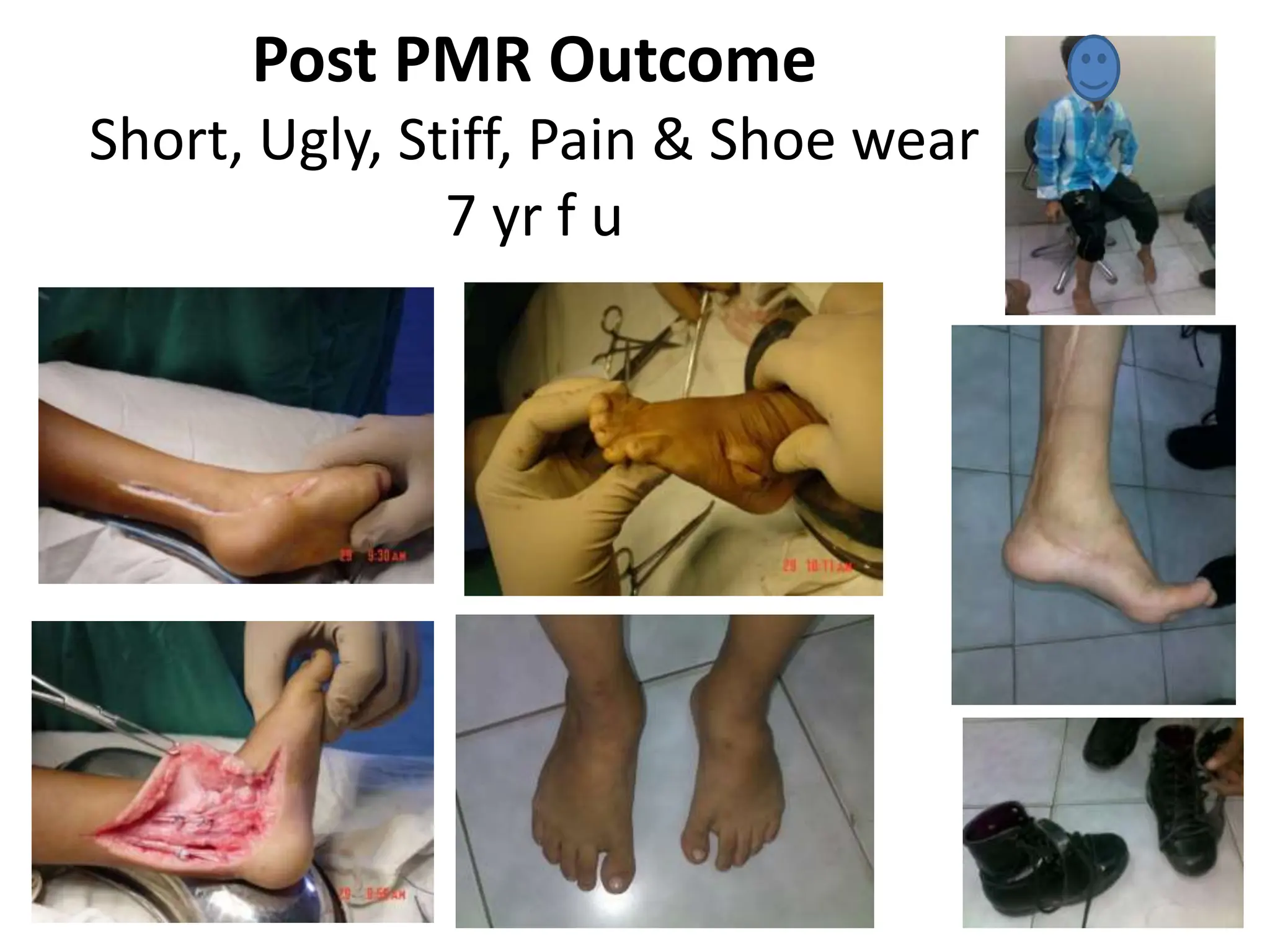 Why Ponseti Technique in Clubfoot management MARCH 2022.pptx