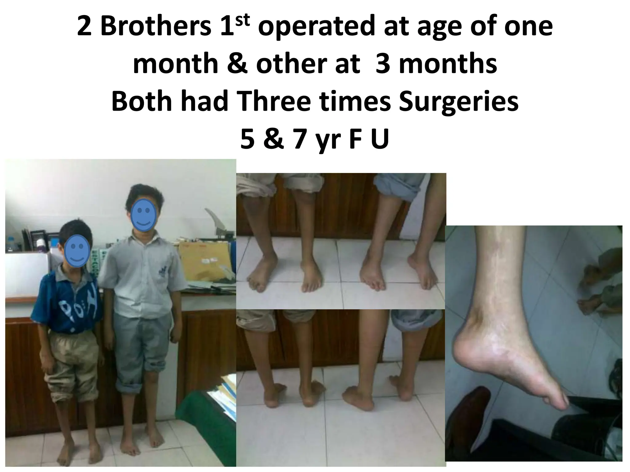 Why Ponseti Technique in Clubfoot management MARCH 2022.pptx