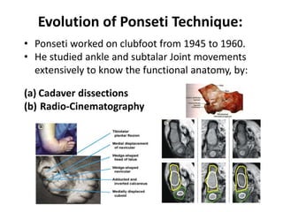 Why Ponseti Technique in Clubfoot management MARCH 2022.pptx